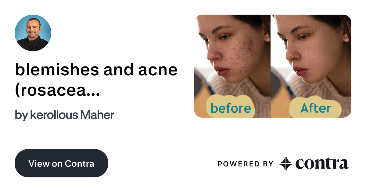 blemishes and acne (rosacea) removal | skin retouching by kerollous Maher